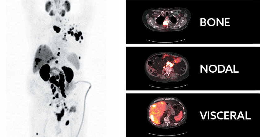 About mCRPC | PLUVICTO | HCP
